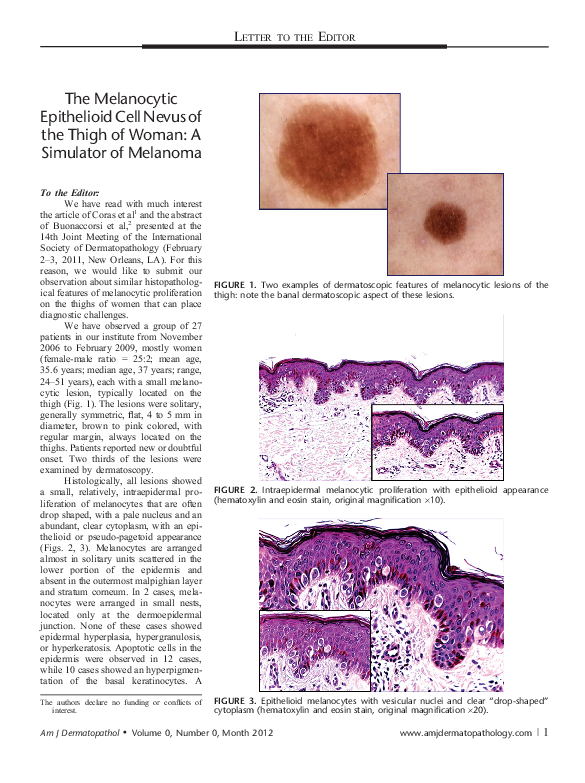 (PDF) The Melanocytic Epithelioid Cell Nevus of the Thigh of Woman