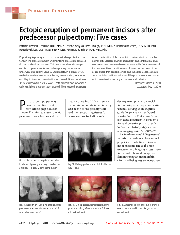 (PDF) Ectopic eruption of permanent incisors after predecessor ...