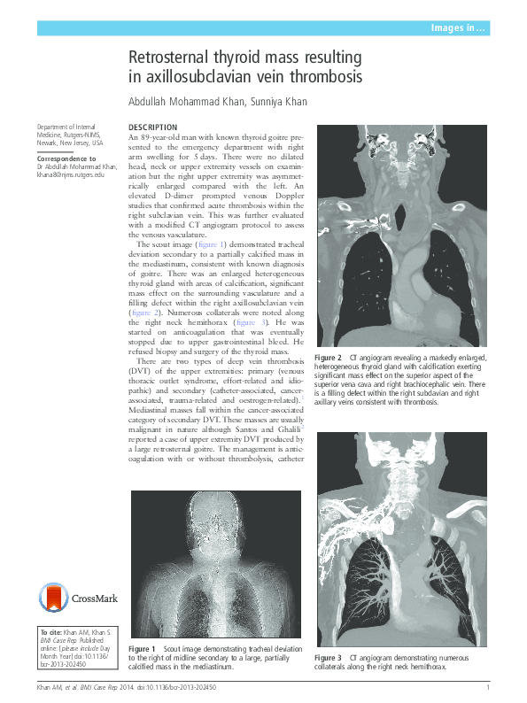 (PDF) Retrosternal thyroid mass resulting in axillosubclavian vein ...