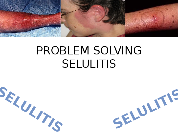 (PPT) fundamental patofisiologi SELULITIS