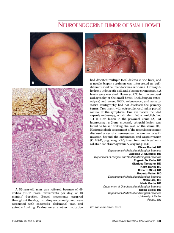 (PDF) Neuroendocrine tumor of small bowel