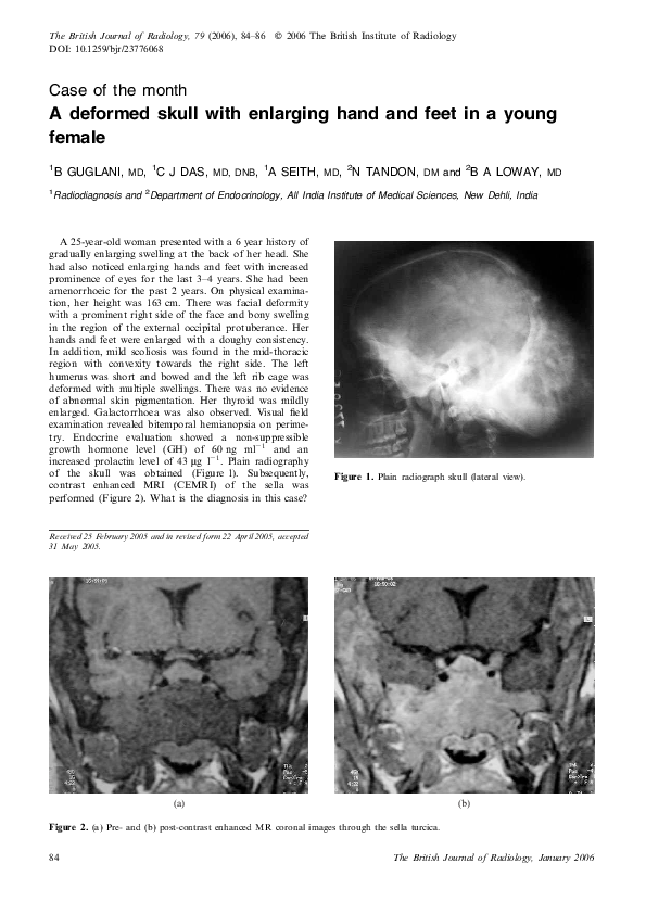 (PDF) A deformed skull with enlarging hand and feet in a young female