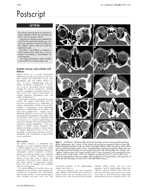 (PDF) Orbital varices and orbital wall defects Orbital varices are a ...