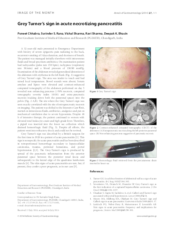 (PDF) Grey Turner's sign in acute necrotizing pancreatitis