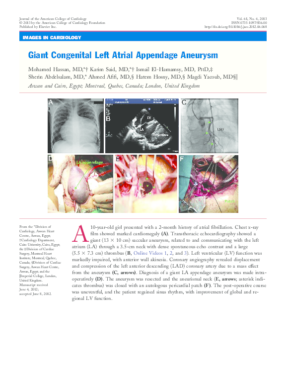(PDF) Giant congenital left atrial appendage aneurysm