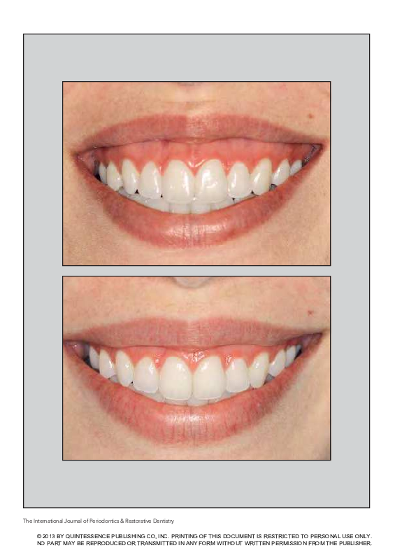 (PDF) Excessive gingival display: treatment by a modified lip ...
