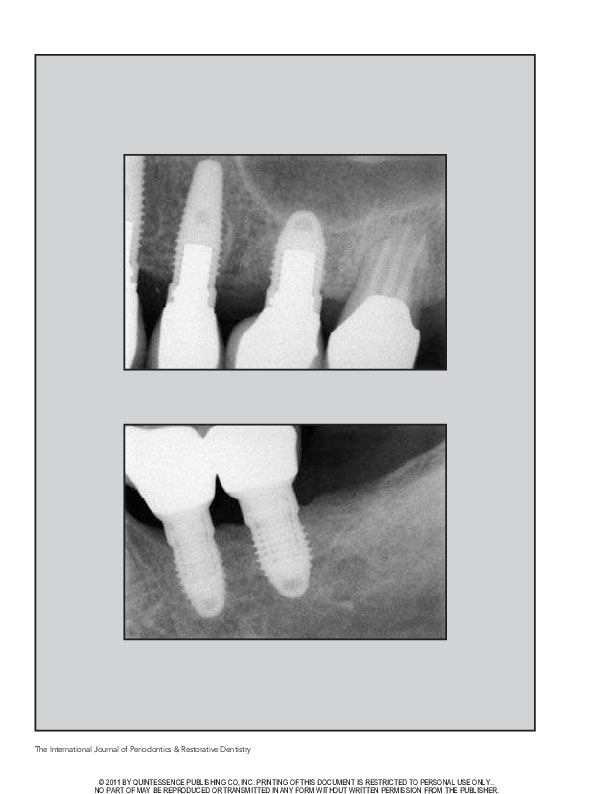 (PDF) Multicenter retrospective analysis of 201 consecutively placed camlog dental implants
