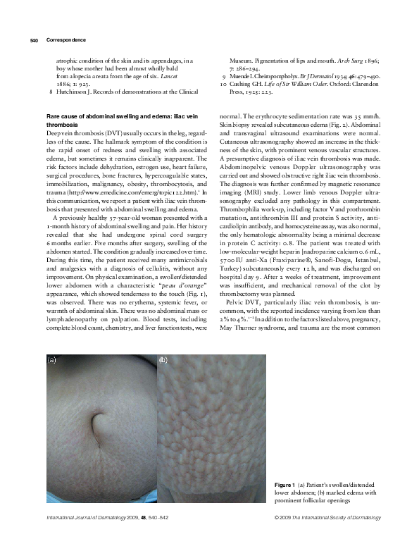 (PDF) Rare cause of abdominal swelling and edema: iliac vein thrombosis