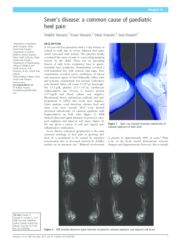 (PDF) Sever's disease: a common cause of paediatric heel pain