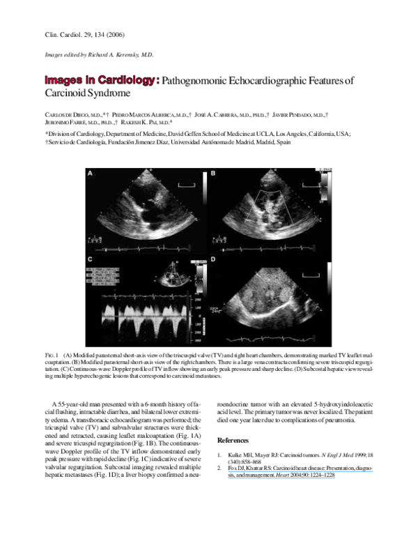 (PDF) Pathognomonic echocardiographic features of carcinoid syndrome