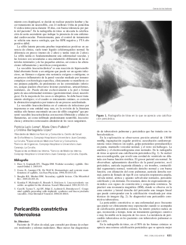 (PDF) Pericarditis constrictiva tuberculosa