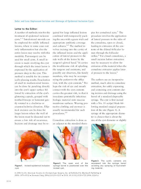 (PDF) Safer and Less Unpleasant Incision and Drainage of Epidermal ...