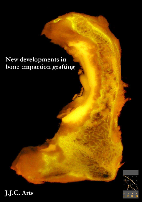 (PDF) New developments in bone impaction grafting