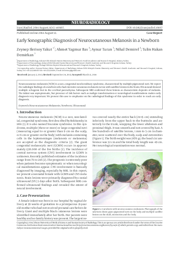 (PDF) Early Sonographic Diagnosis of Neurocutaneous Melanosis in an ...