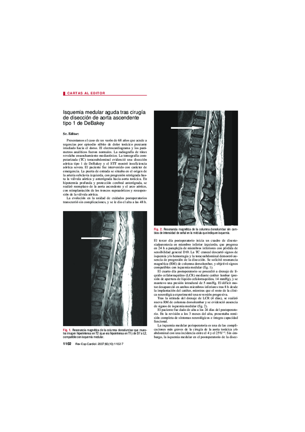(PDF) Isquemia medular aguda tras cirugía de disección de aorta ...