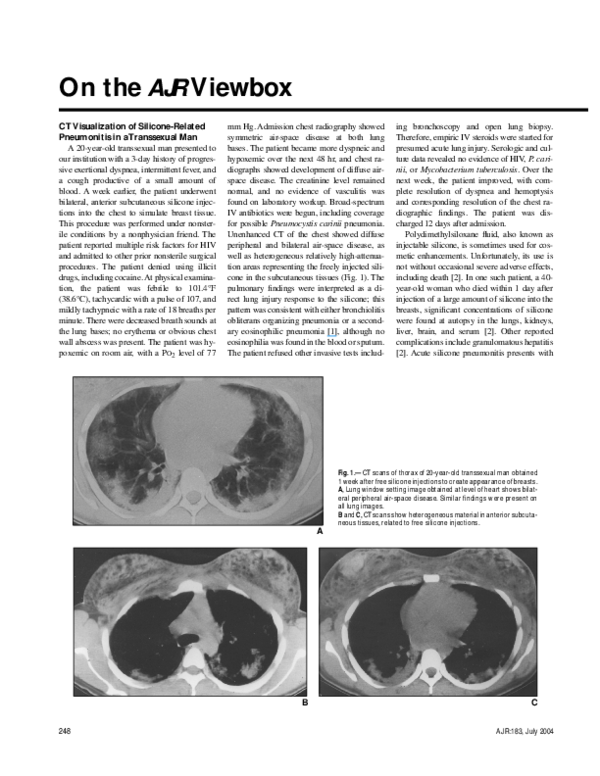(PDF) MDCT of Intraluminal “Windsock” Duodenal Diverticulum with ...