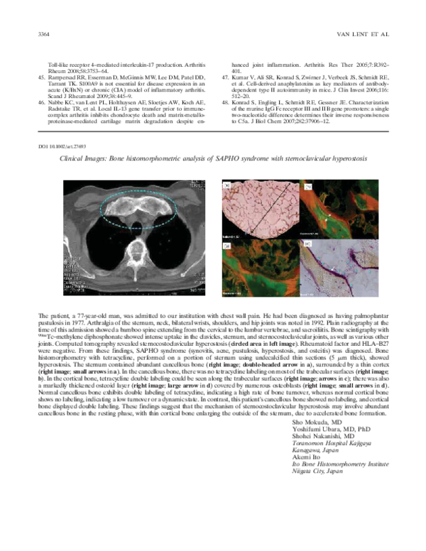 (PDF) Clinical Image: Bone histomorphometric analysis of SAPHO syndrome ...