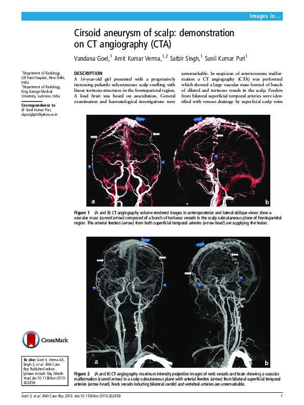 (PDF) Cirsoid aneurysm of scalp: demonstration on CT angiography (CTA)