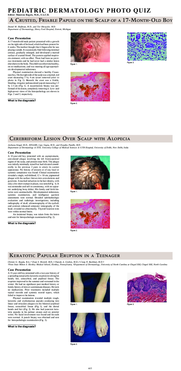 (PDF) Cerebriform Lesion Over Scalp with Alopecia