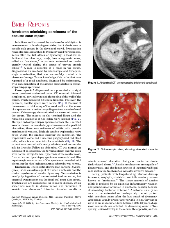 (PDF) Ameboma mimicking carcinoma of the cecum: case report | Yasemin ...