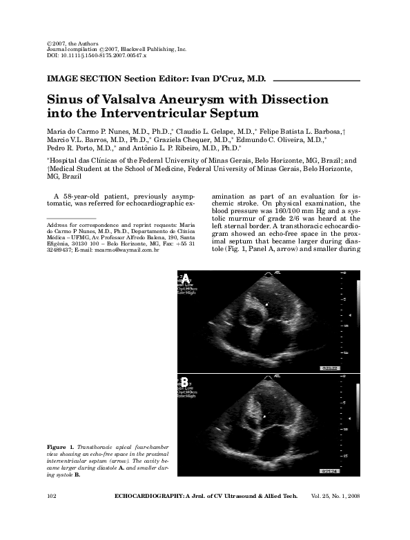 (PDF) Sinus of Valsalva Aneurysm with Dissection into the ...