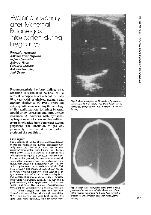 (PDF) Hydranencephaly after Maternal Butane-gas Intoxication during ...