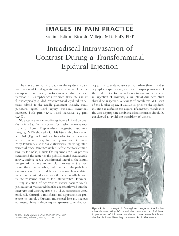 (PDF) Intradiscal Intravasation of Contrast During a Transforaminal ...