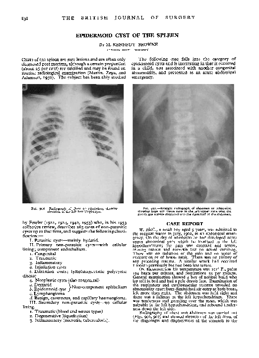 Pdf Epidermoid Cyst Of The Spleen