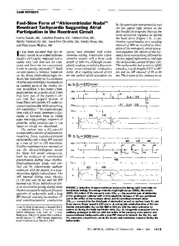 (PDF) Fast-slow form of “atrioventricular nodal” reentrant tachycardia suggesting atrial ...