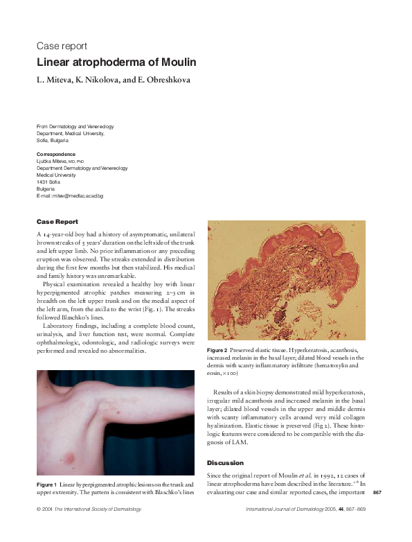 (PDF) Linear atrophoderma of Moulin