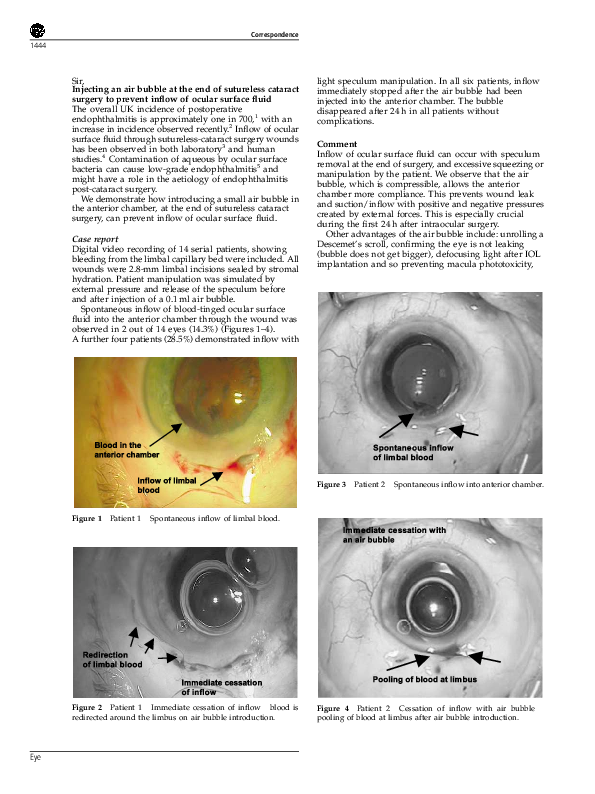 (PDF) Injecting an air bubble at the end of sutureless cataract surgery ...