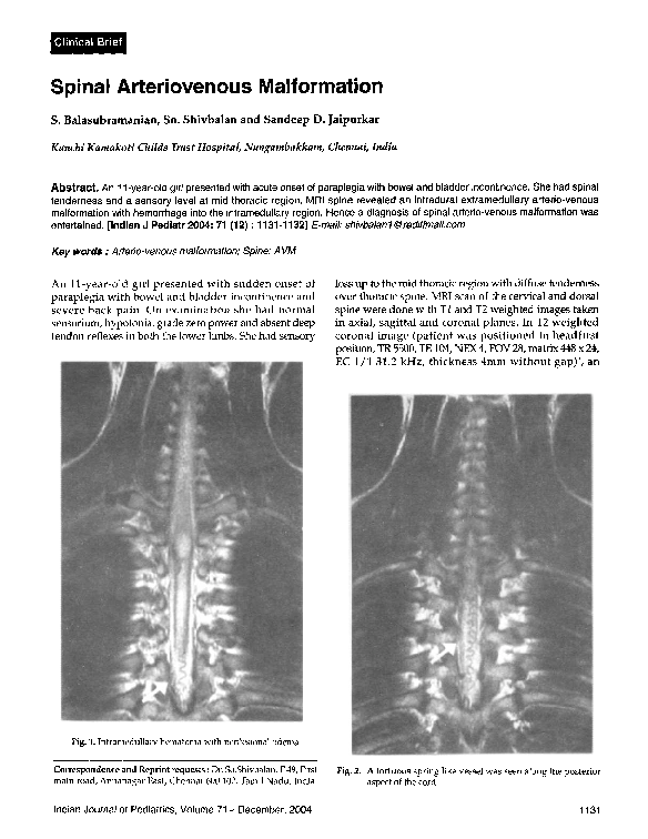 (PDF) Spinal arteriovenous malformation