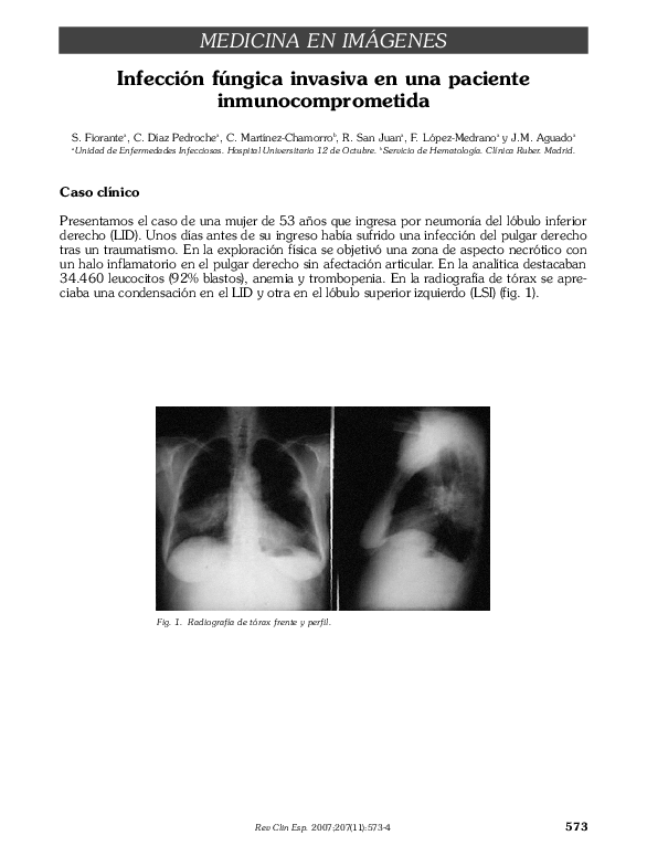 (PDF) Infección fúngica invasiva en una paciente inmunocomprometida