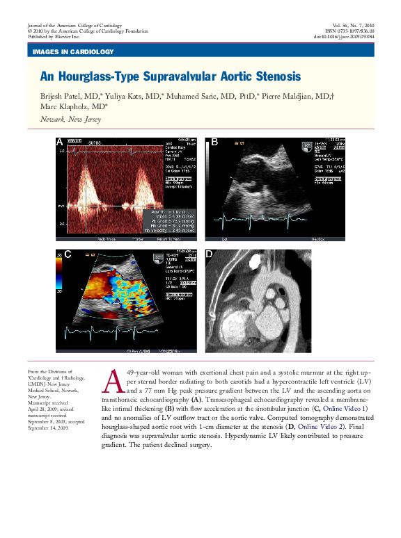 (PDF) An Hourglass-Type Supravalvular Aortic Stenosis