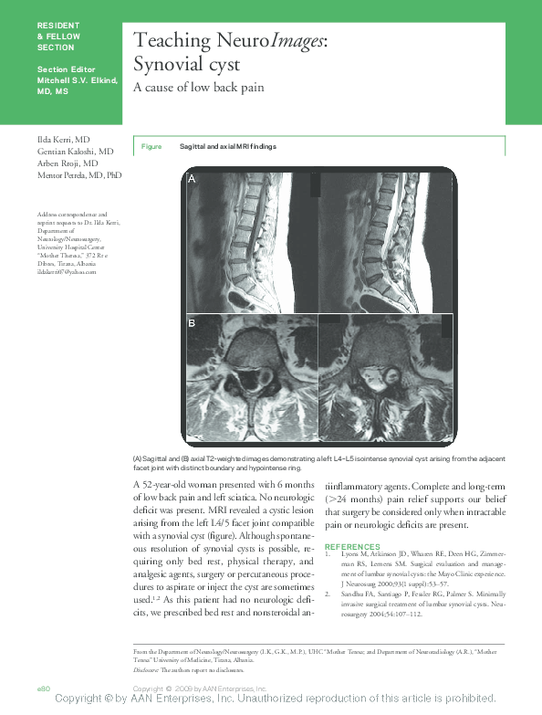 (PDF) Teaching NeuroImages: Synovial cyst: A cause of low back pain