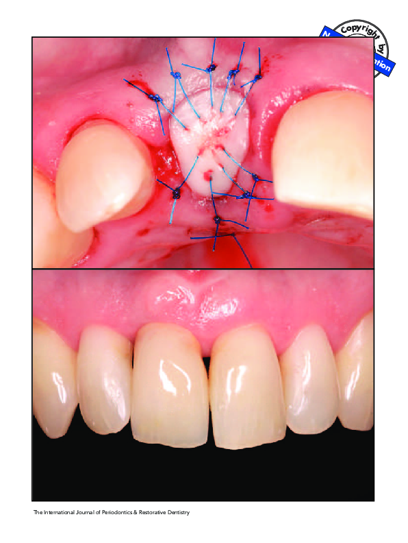 (PDF) Use of a combination epithelized-subepithelial connective tissue ...