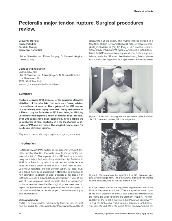(PDF) Pectoralis major tendon rupture. Surgical procedures review ...