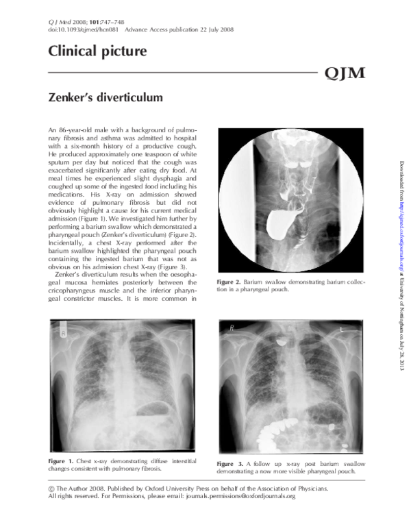 (PDF) Zenker's diverticulum