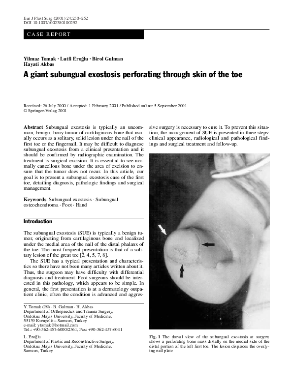 (PDF) A giant subungual exostosis perforating through skin of the toe