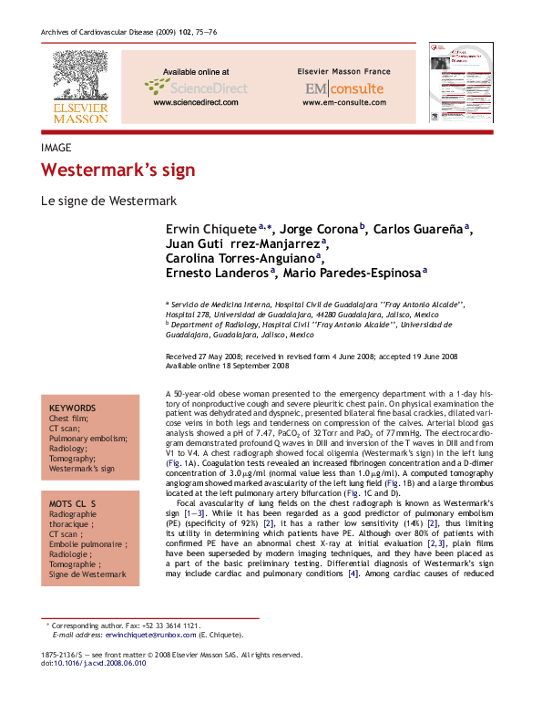 (PDF) Westermark's sign