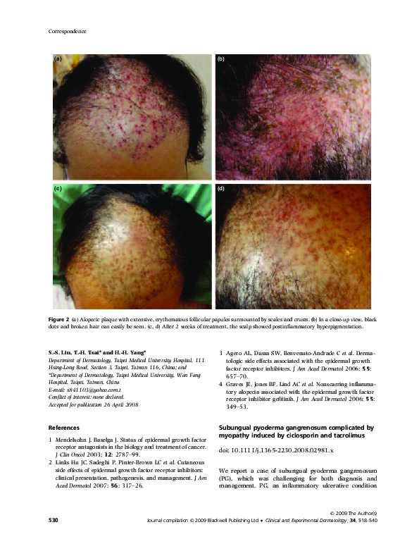 (PDF) Subungual pyoderma gangrenosum complicated by myopathy induced by ...