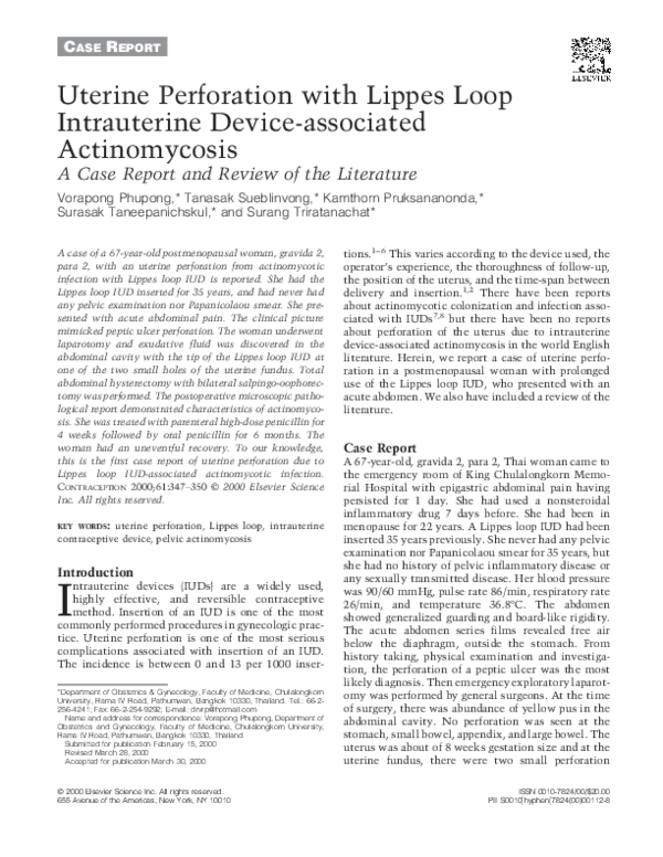 (PDF) Uterine perforation with Lippes loop intrauterine device ...