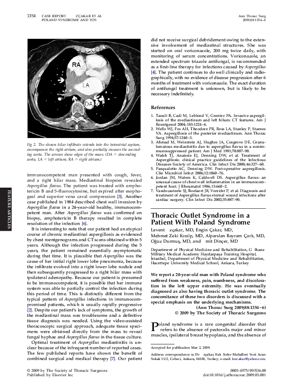 (PDF) Thoracic Outlet Syndrome in a Patient With Poland Syndrome