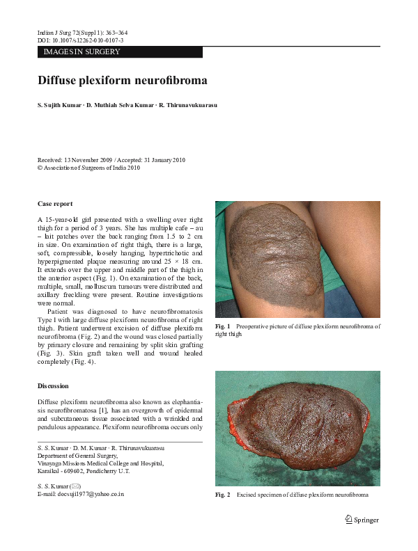 (PDF) Diffuse plexiform neurofibroma