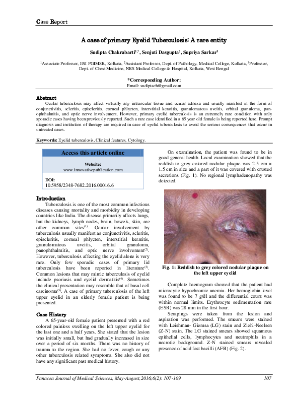 (PDF) Primary Conjunctival Tuberculosis Presenting as Dry Eye: A Rare ...