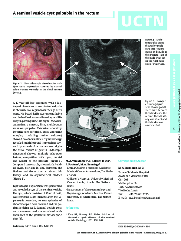 (PDF) A seminal vesicle cyst palpable in the rectum