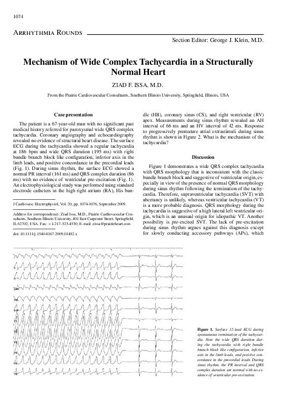 (PDF) Mechanism of Wide Complex Tachycardia in a Structurally Normal Heart