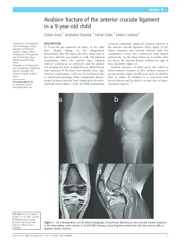 (PDF) Avulsion fracture of the anterior cruciate ligament in a 9-year ...