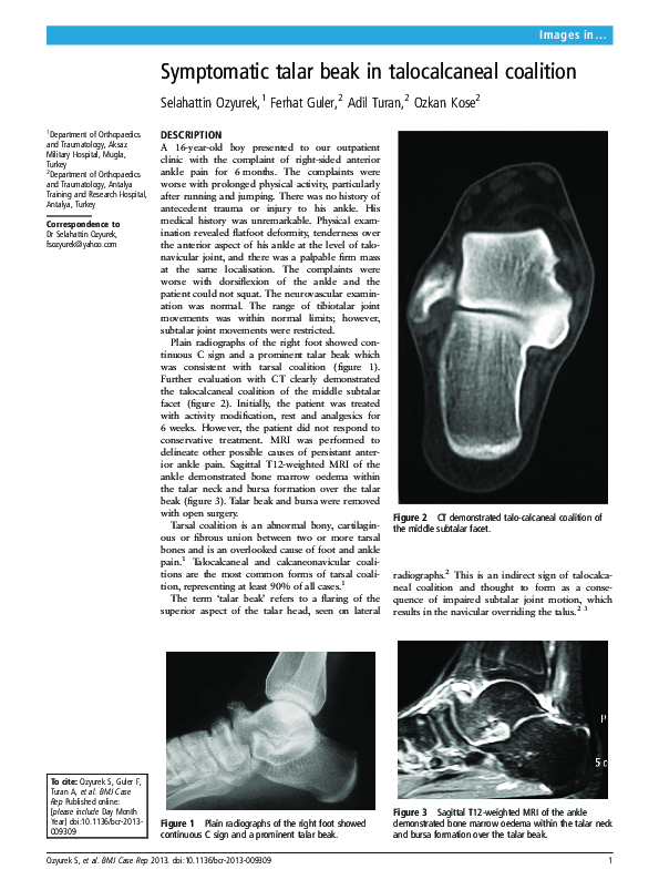 (PDF) Symptomatic talar beak in talocalcaneal coalition