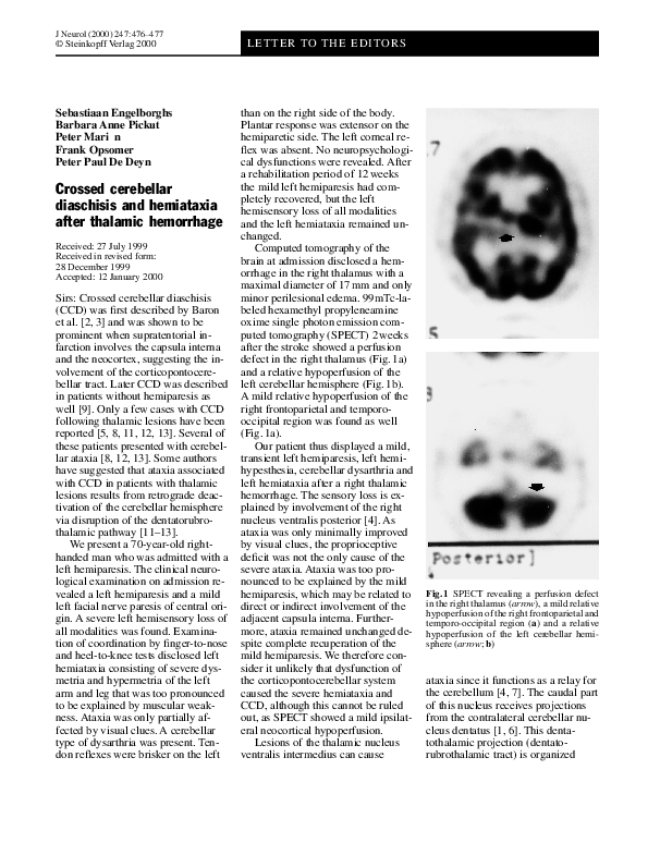 (PDF) Crossed cerebellar diaschisis and hemiataxia after thalamic ...